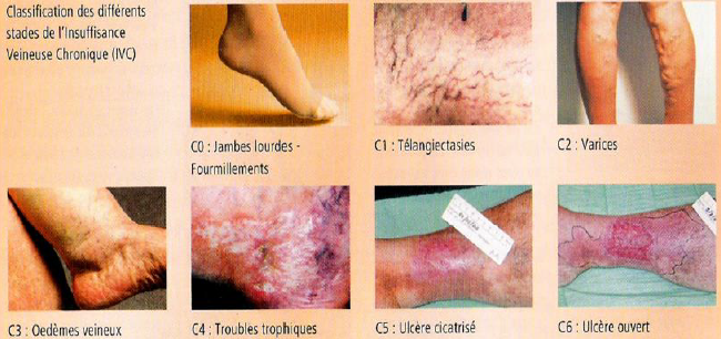 L’insuffisance veineuse – Il était une fois… la cicatrisation